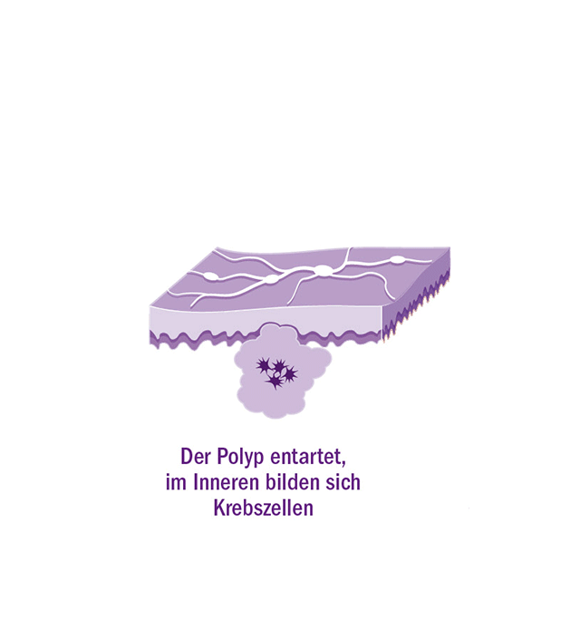 Darmpolypen: Entstehung, Entfernung, Vorbeugung | SBK