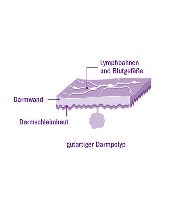 Darmpolypen: Entstehung, Entfernung, Vorbeugung | SBK
